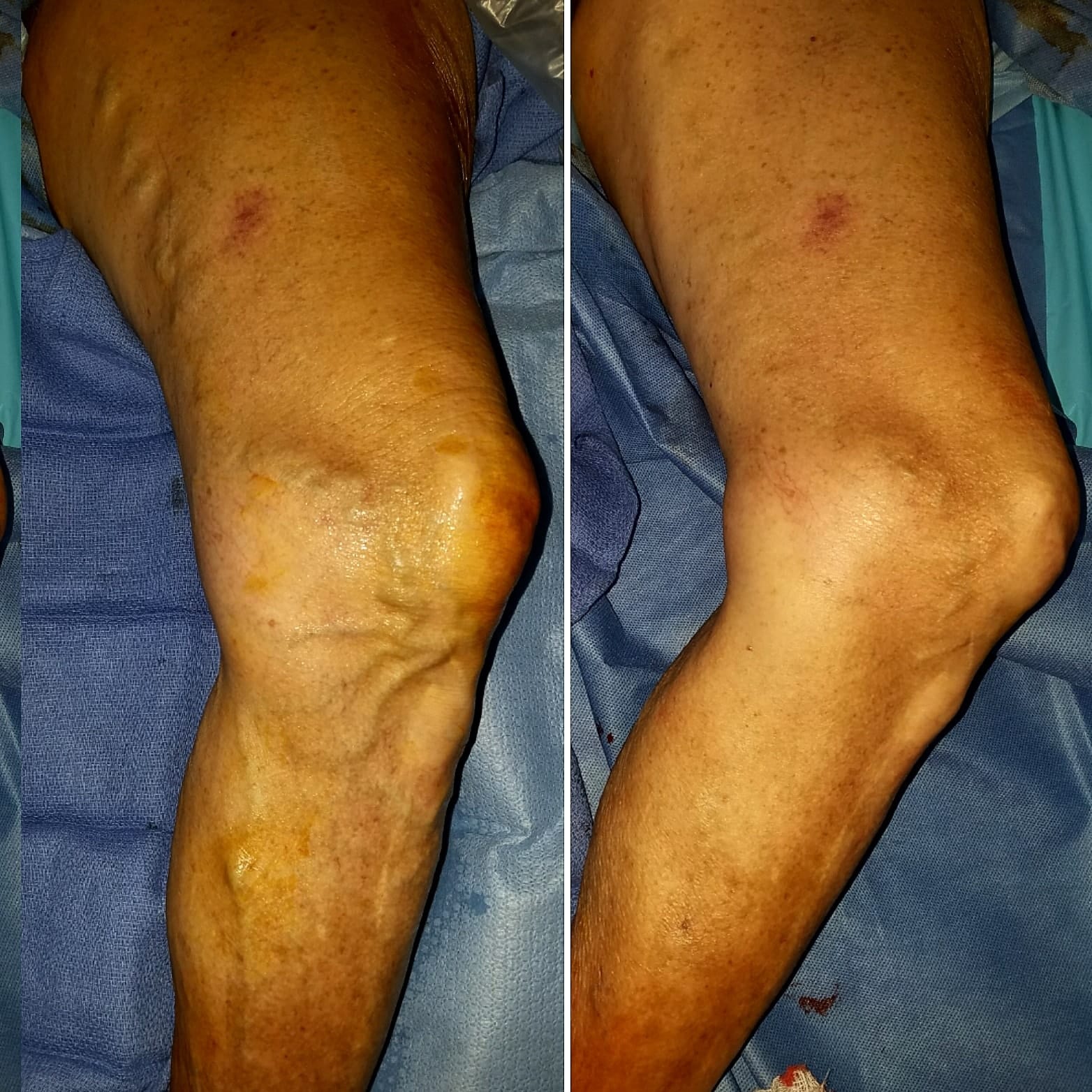 Greater Saphenous Vein Thrombosis Treatment