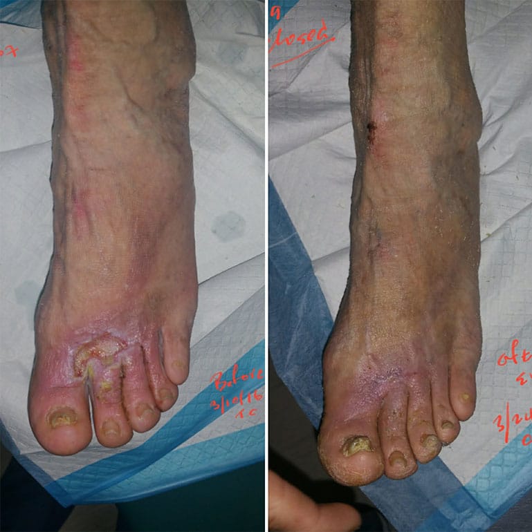 Venous Ulcer Vs Arterial Ulcer