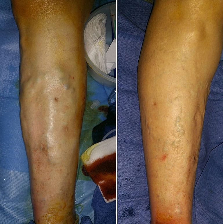 Superficial Thrombophlebitis Leg